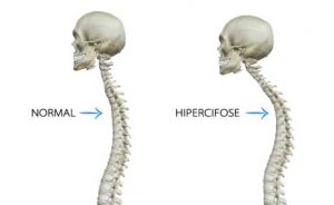 Tratamento de Cifose - Coluna SP