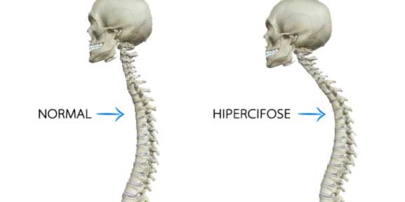 Tratamento de Cifose - Coluna SP